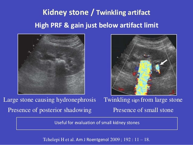 Indications of renal doppler ultrasound 3