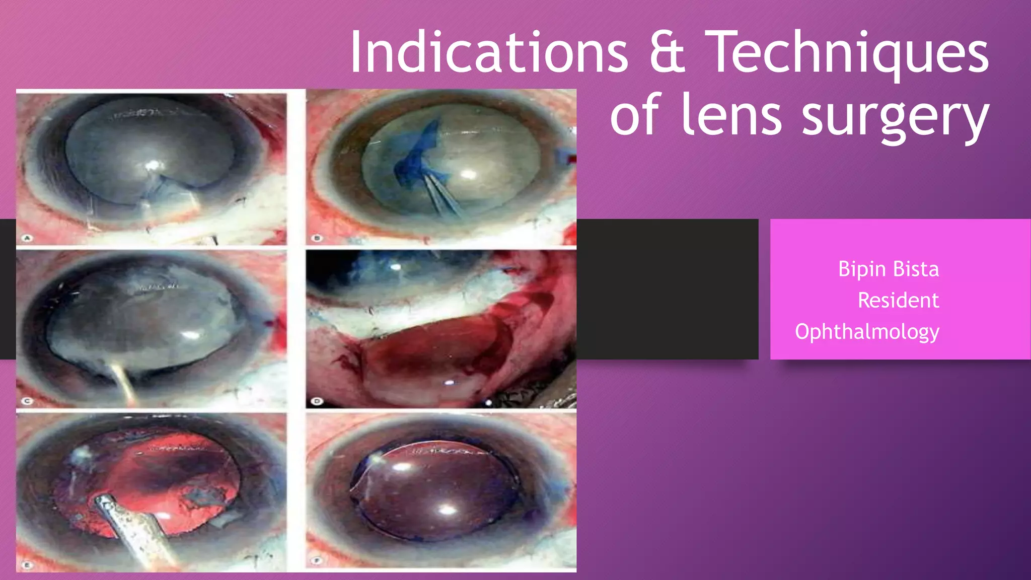Indications & techniques of lens surgery | PPTX | Eye and Vision ...