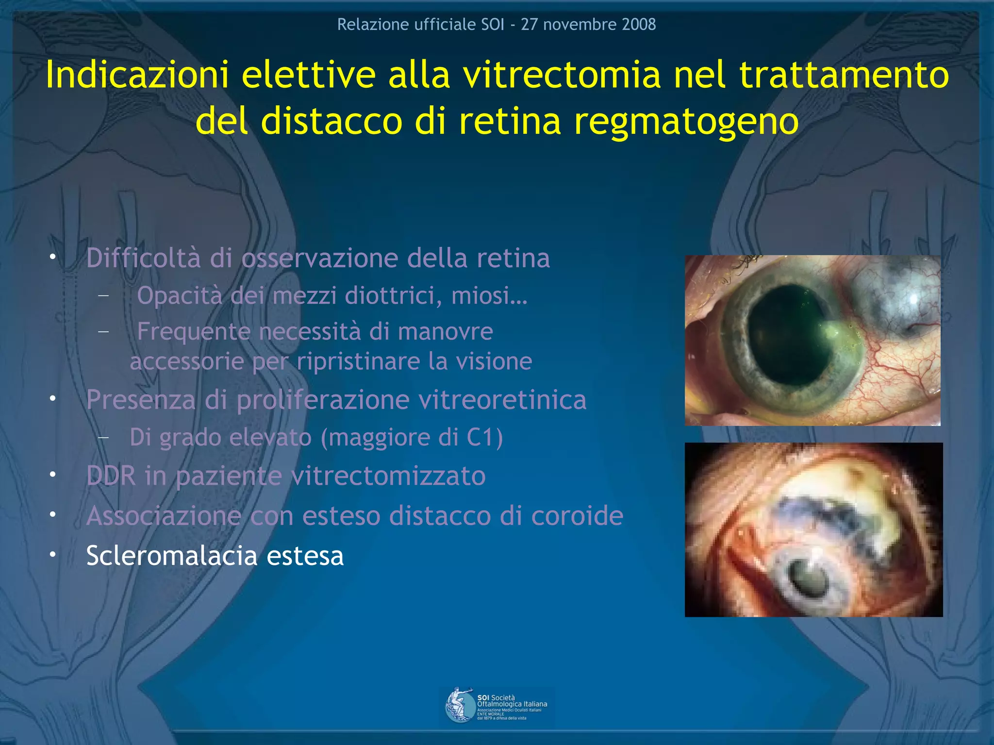 Indicazioni vitrectomia soi2008 | PPT