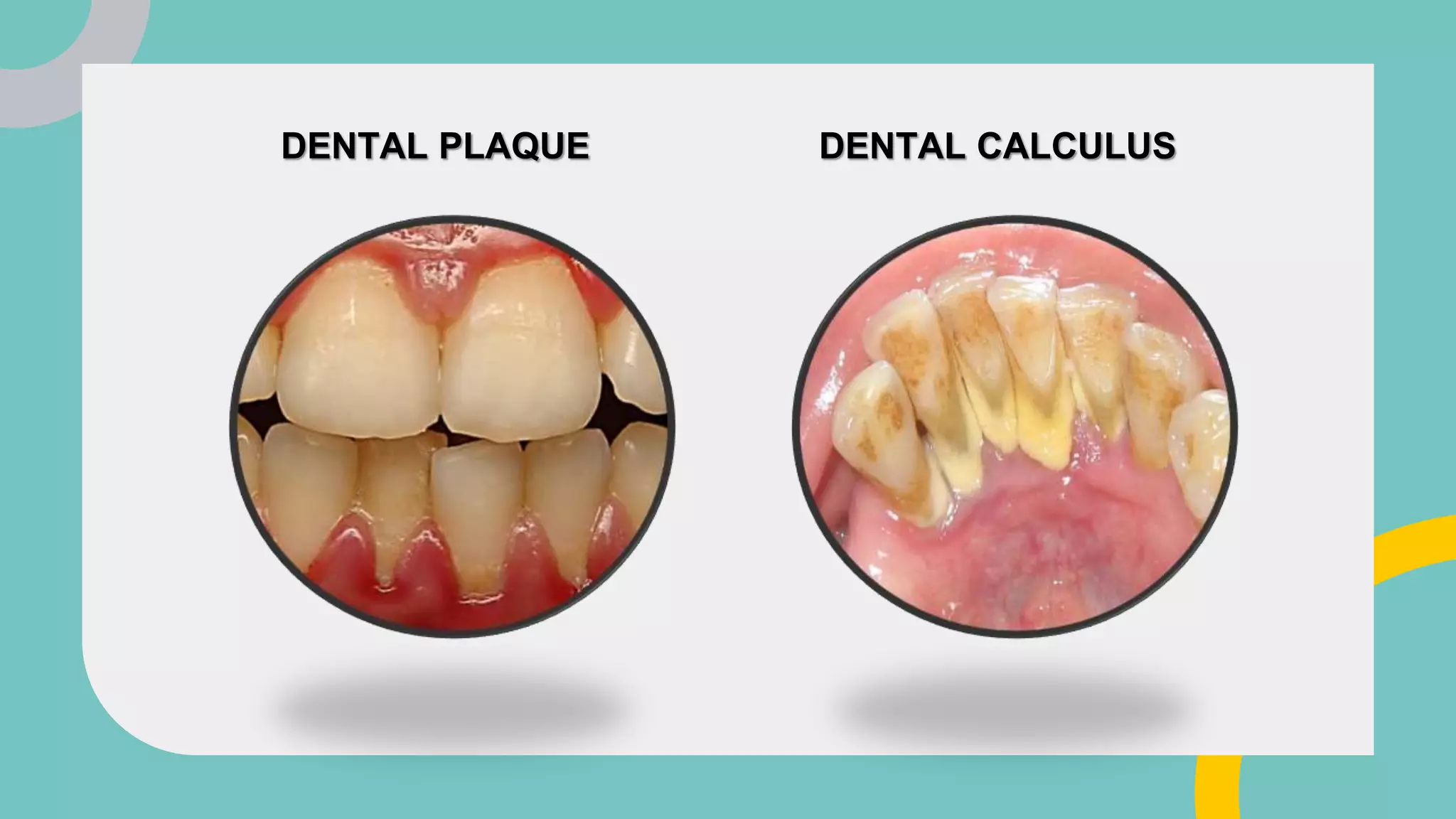 Oral Hygiene Index (OHI) and Oral Hygiene Index-Simplified (OHI-S) | PPTX