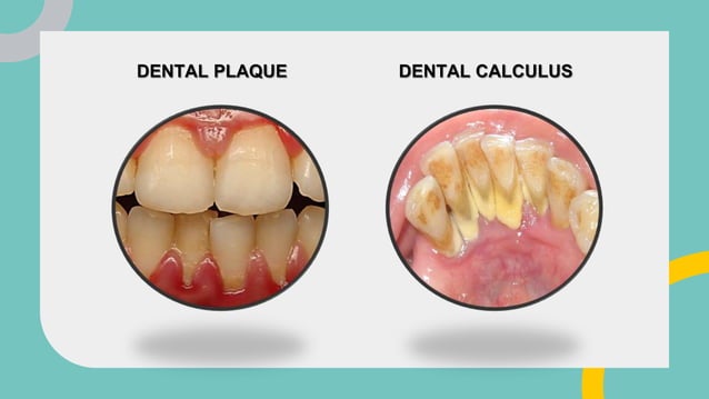 Oral Hygiene Index (OHI) and Oral Hygiene Index-Simplified (OHI-S ...