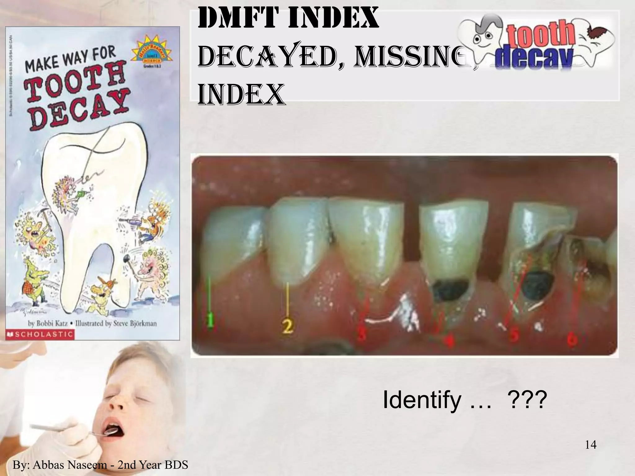Indices for dental caries | PPTX | Dental Health | Diseases and Conditions