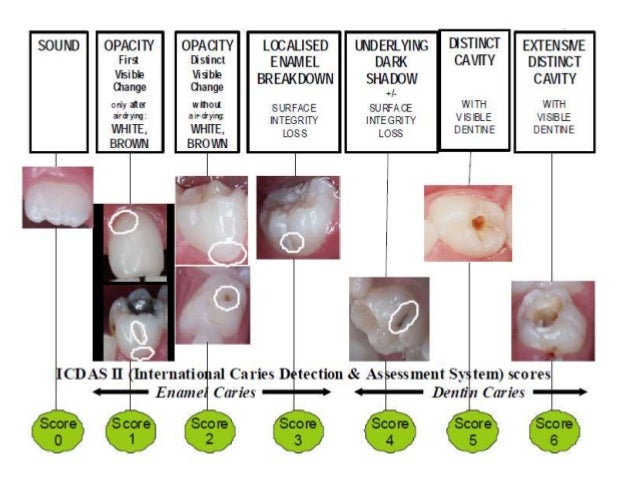 Indices for dental caries