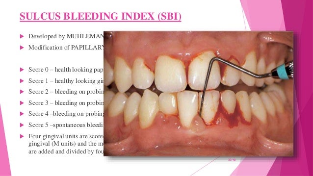 INDICES IN PERIODONTOLOGY