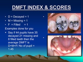 INDICES USED IN DENTISTRY.pptx