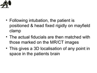 Indigenization Of Fiducials In Image Guided Neurosurgery | PPT