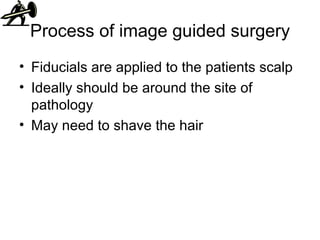 Indigenization Of Fiducials In Image Guided Neurosurgery | PPT