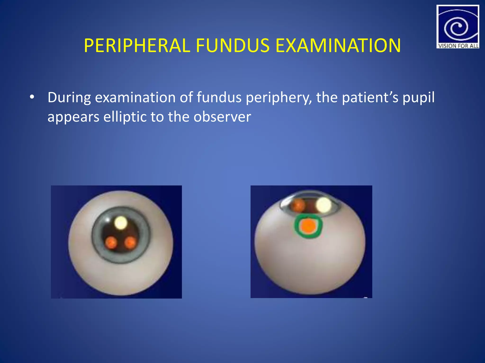 Indirect ophthalmoscopy and fundus drawing | PPTX