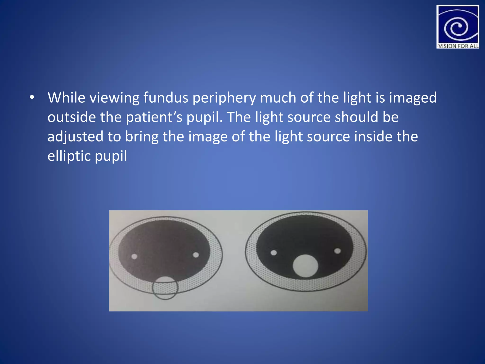 Indirect ophthalmoscopy and fundus drawing | PPTX