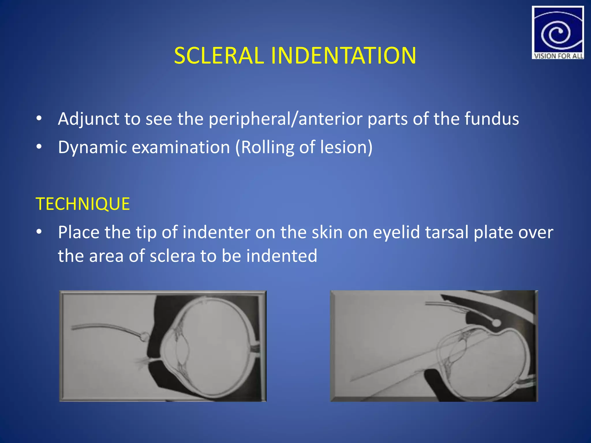 Indirect ophthalmoscopy and fundus drawing | PPTX