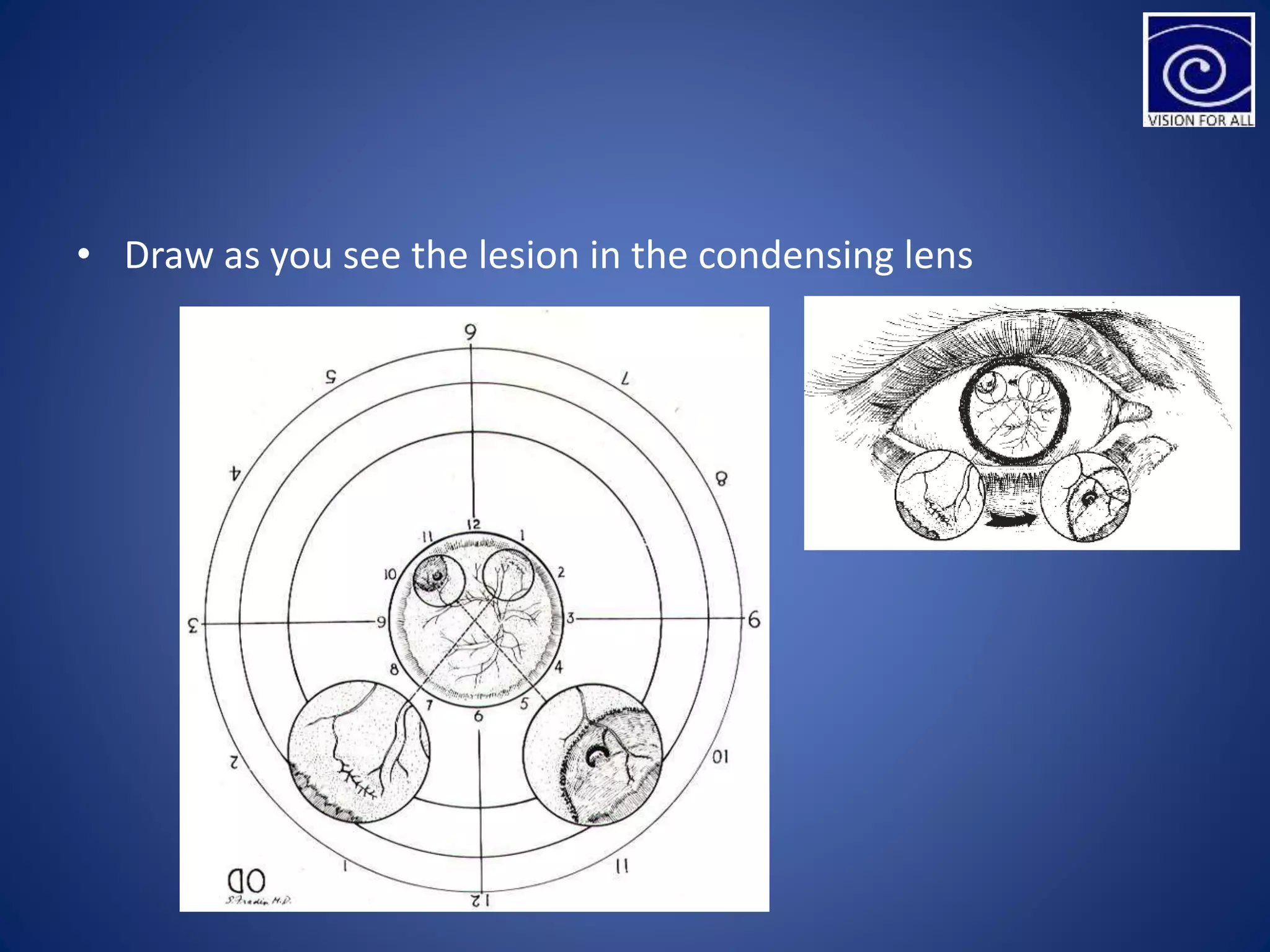 Indirect ophthalmoscopy and fundus drawing | PPTX