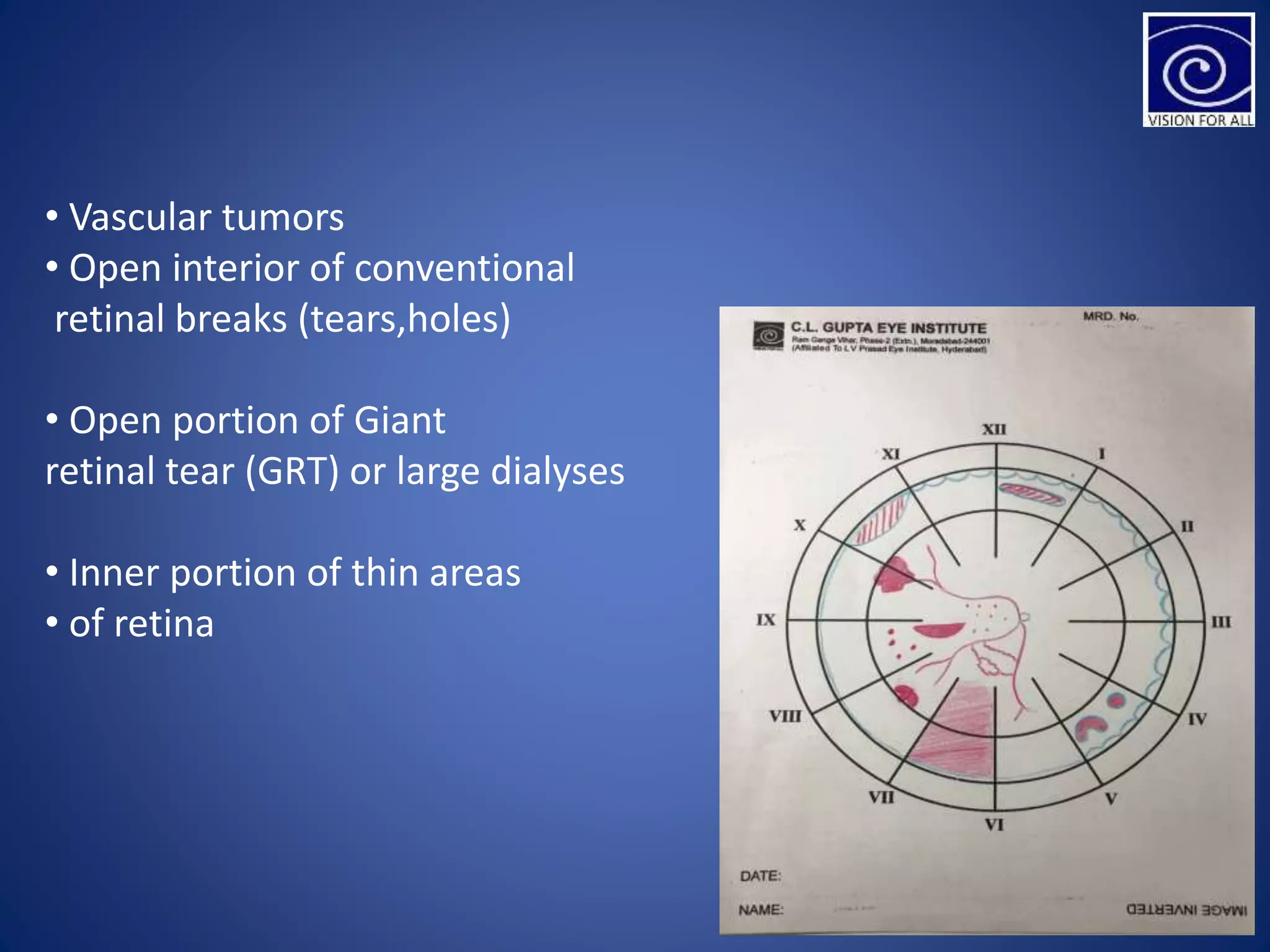 Indirect ophthalmoscopy and fundus drawing | PPTX