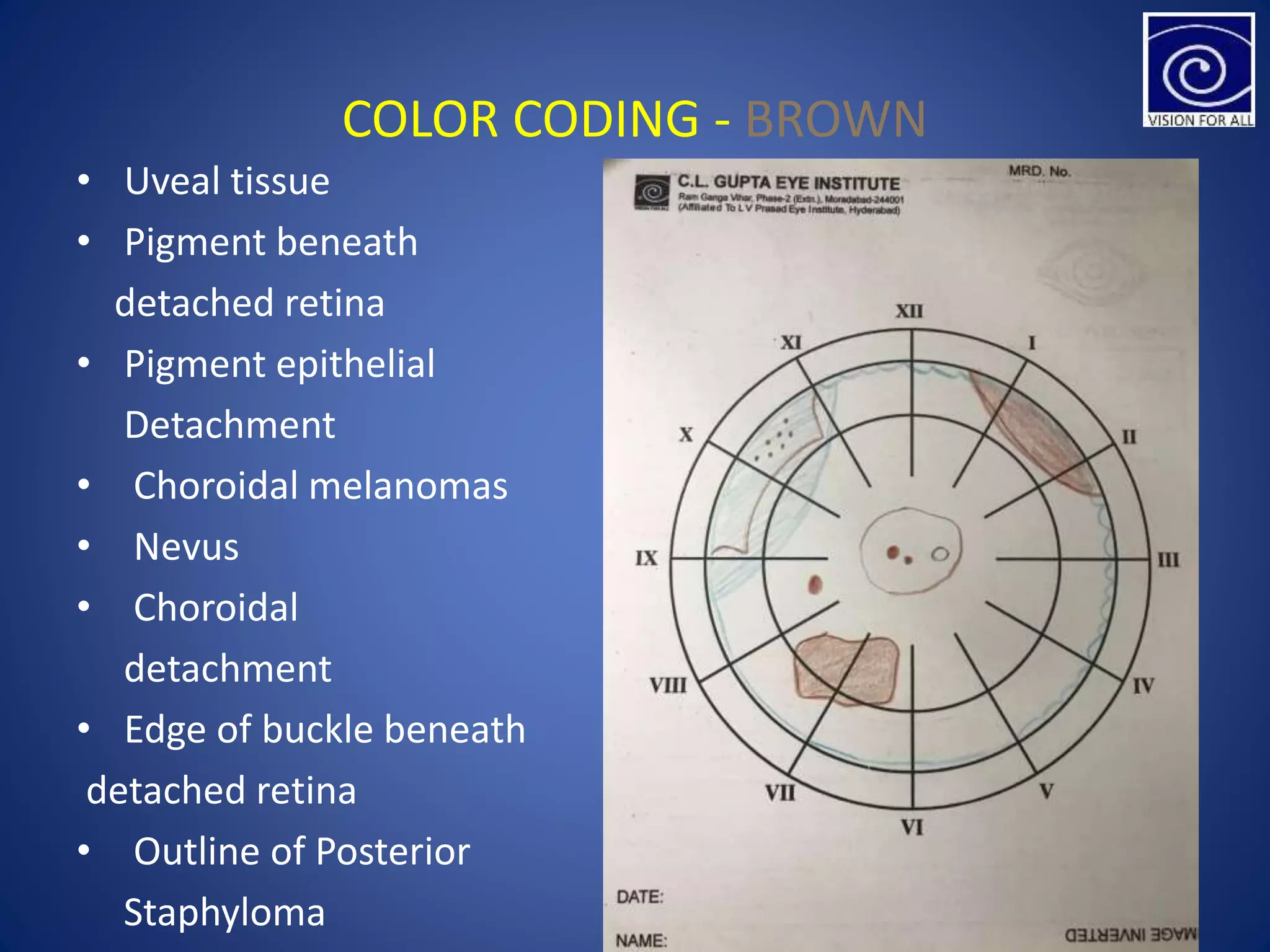 Indirect ophthalmoscopy and fundus drawing | PPTX