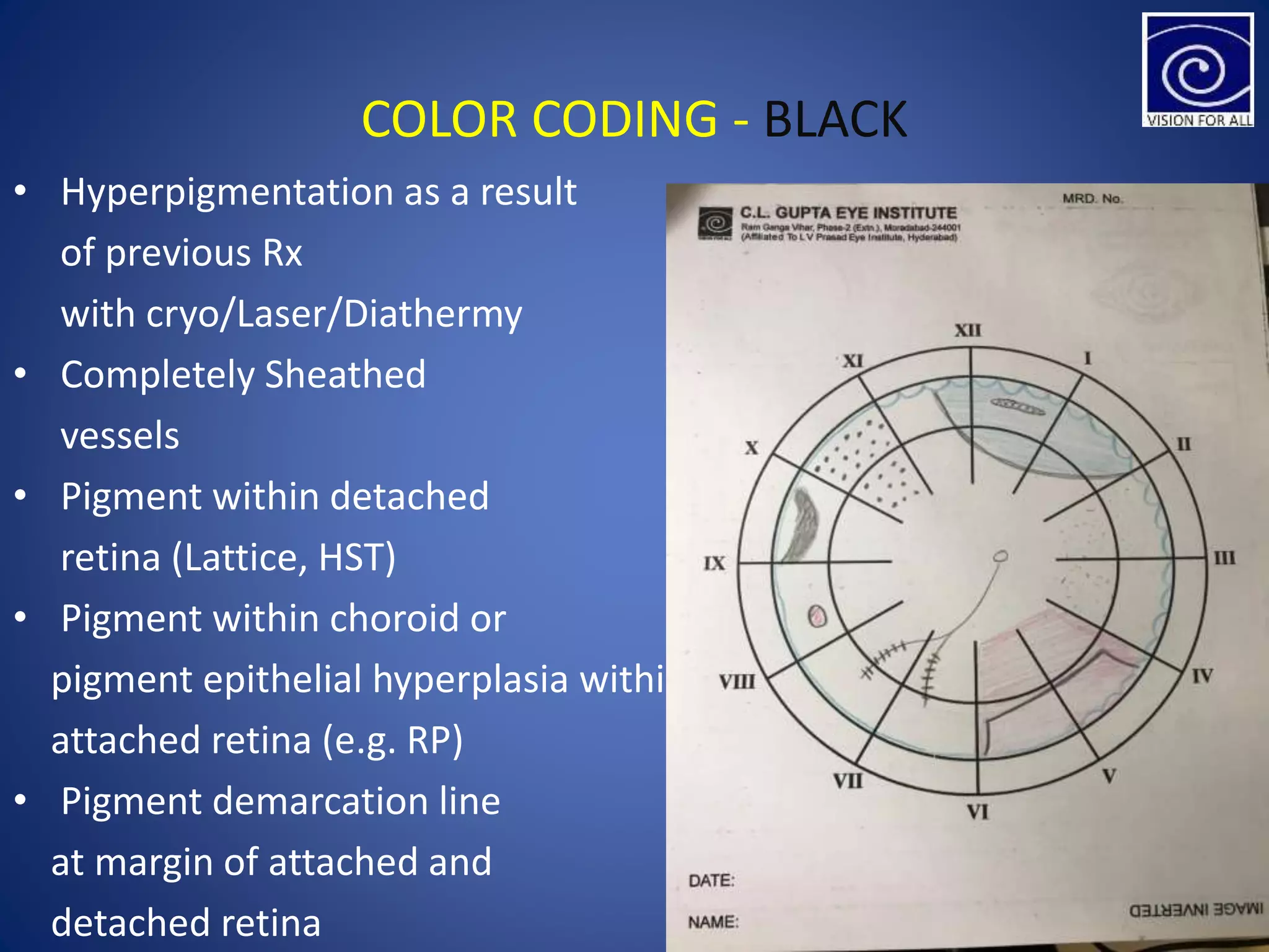 Indirect ophthalmoscopy and fundus drawing | PPTX