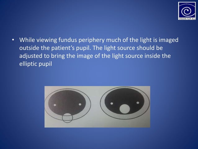 Indirect ophthalmoscopy and fundus drawing | PPTX | Eye and Vision ...