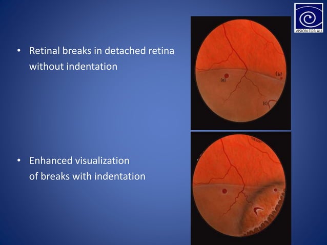 Indirect ophthalmoscopy and fundus drawing | PPTX | Eye and Vision ...