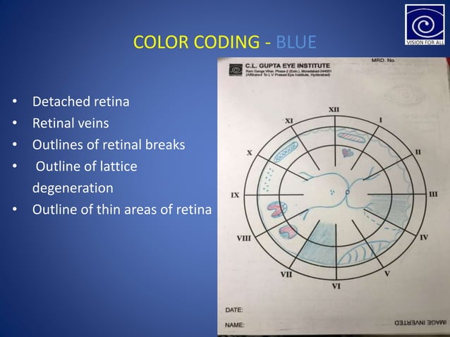 Indirect ophthalmoscopy and fundus drawing | PPTX | Eye and Vision ...