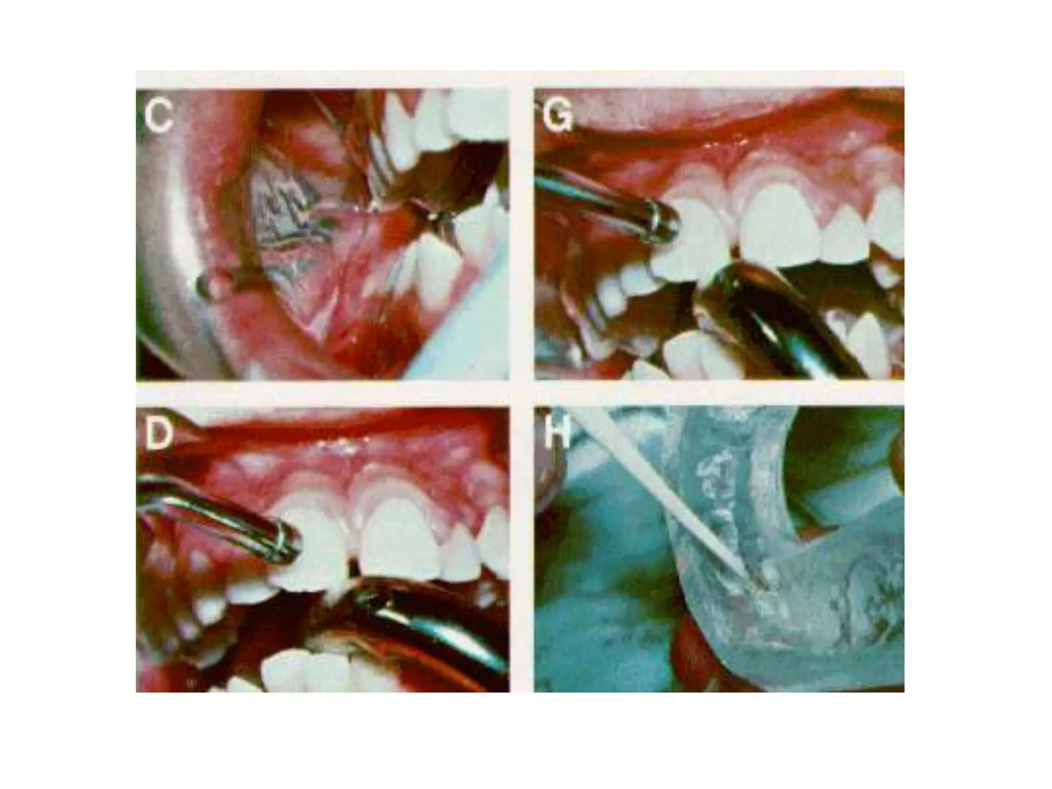 Indirect bonding | PPTX