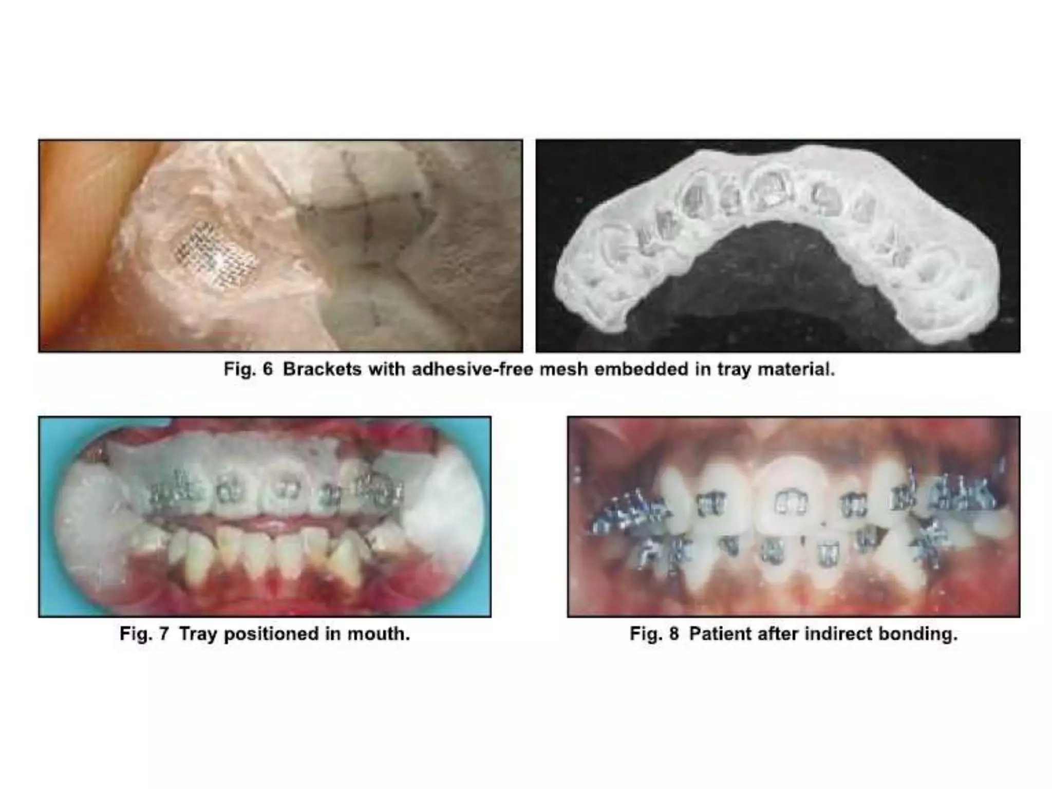 Indirect bonding | PPTX