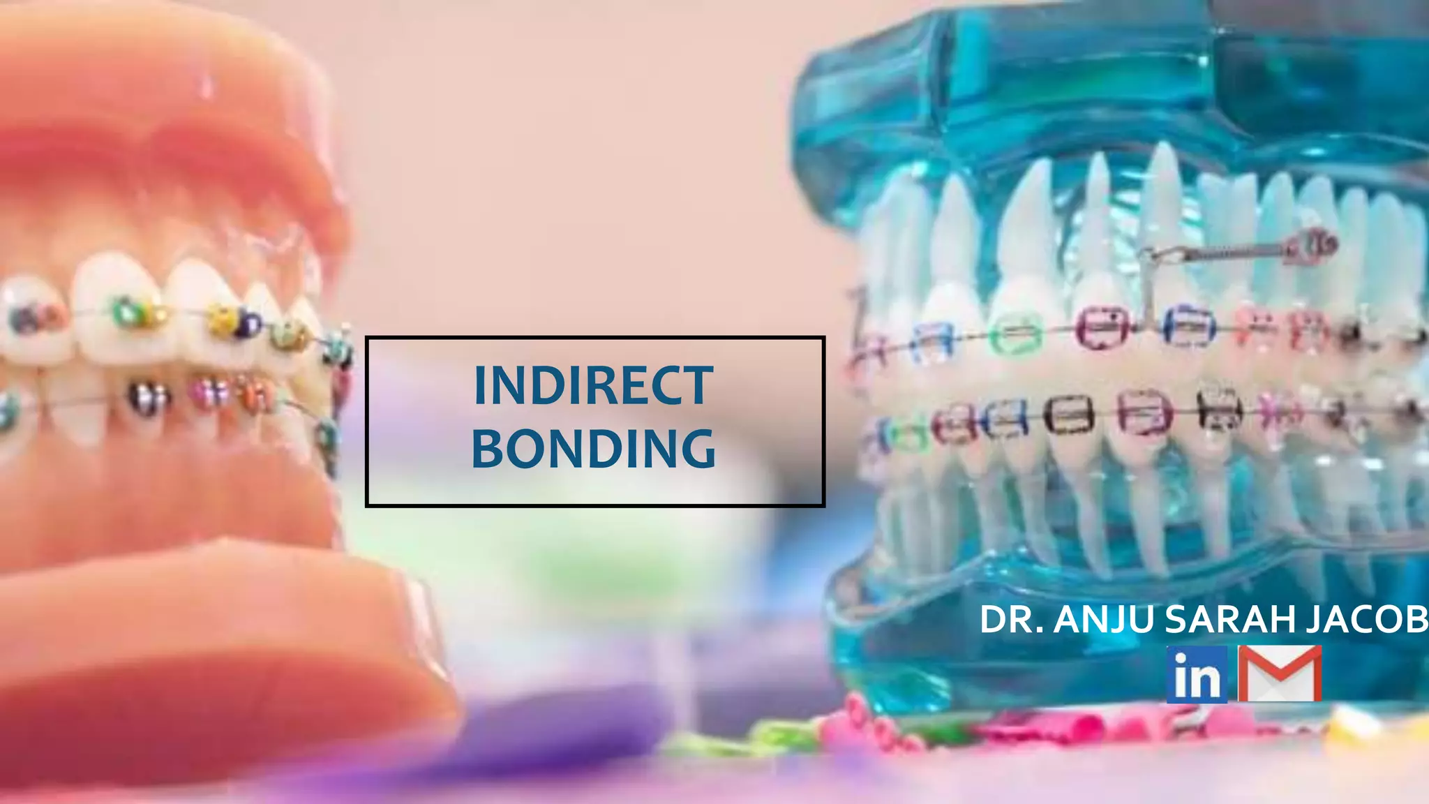 Indirect Bonding in Orthodontics | PPTX