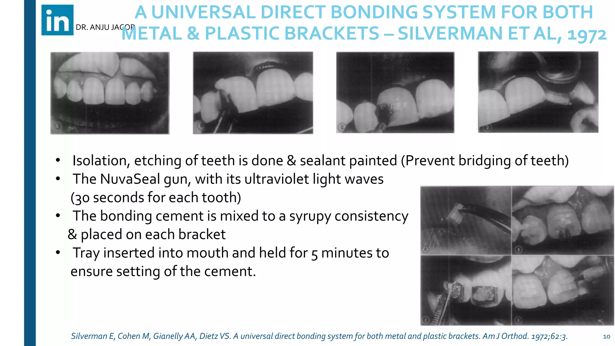 Indirect Bonding in Orthodontics | PPTX