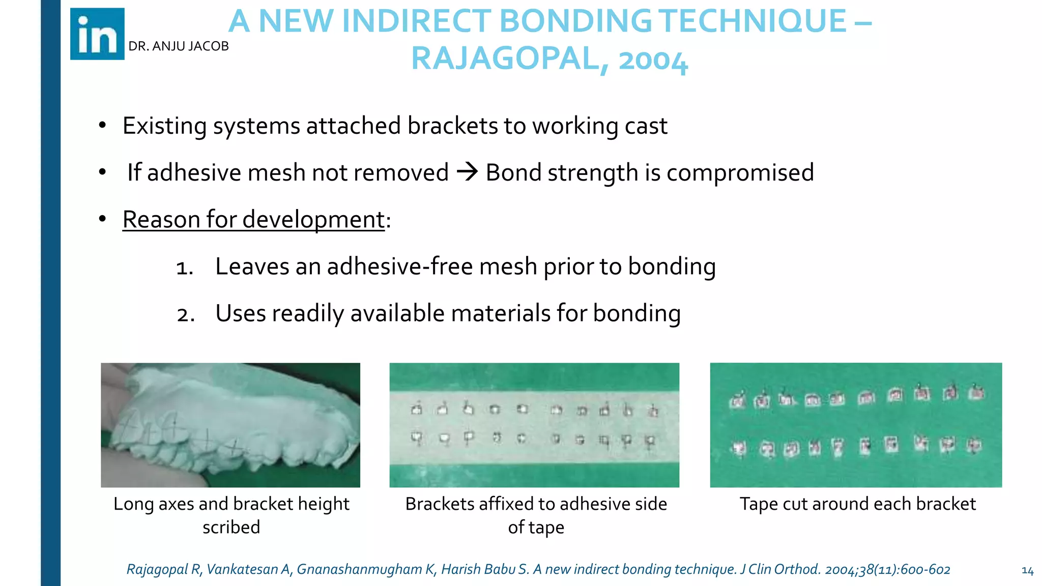 Indirect Bonding in Orthodontics | PPTX