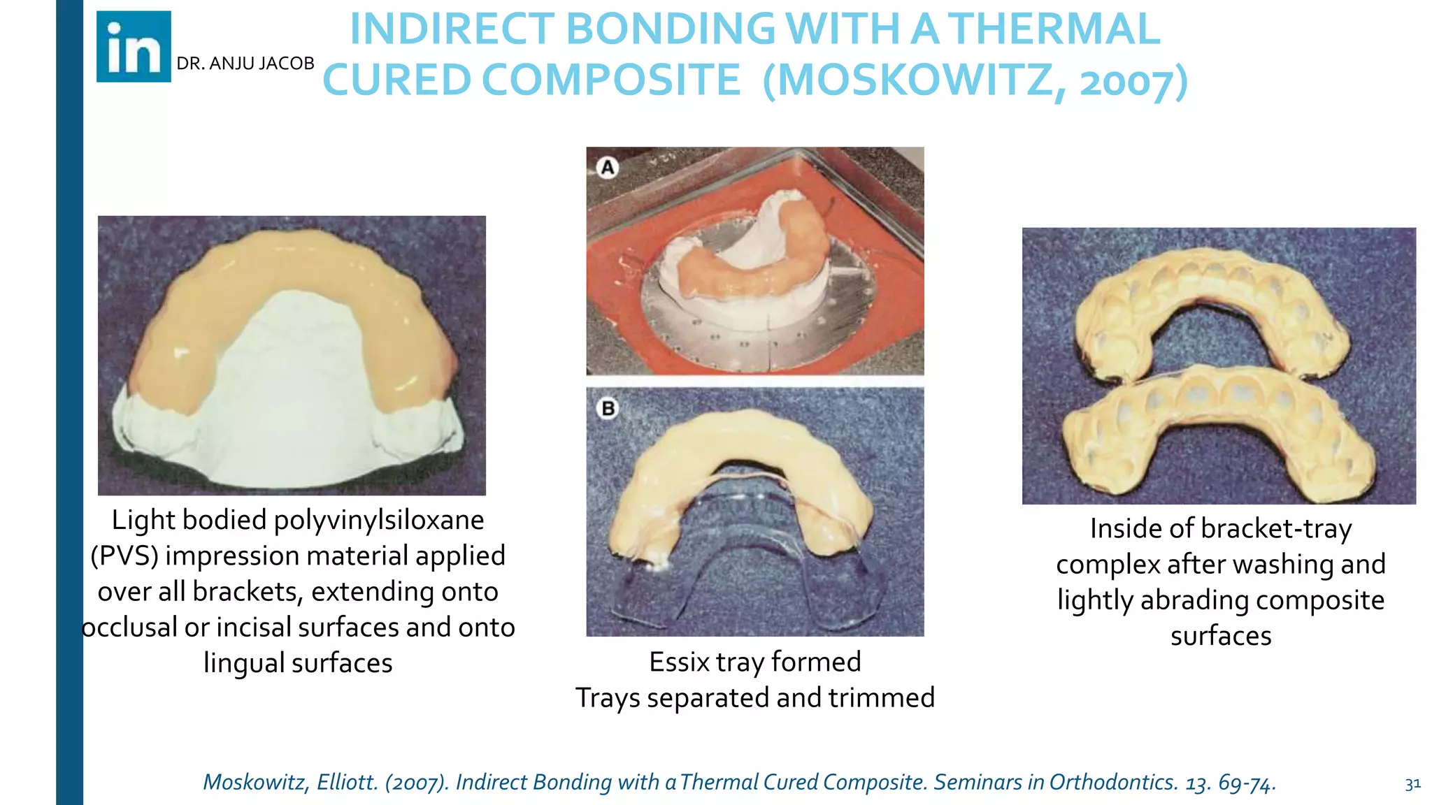 Indirect Bonding in Orthodontics | PPTX