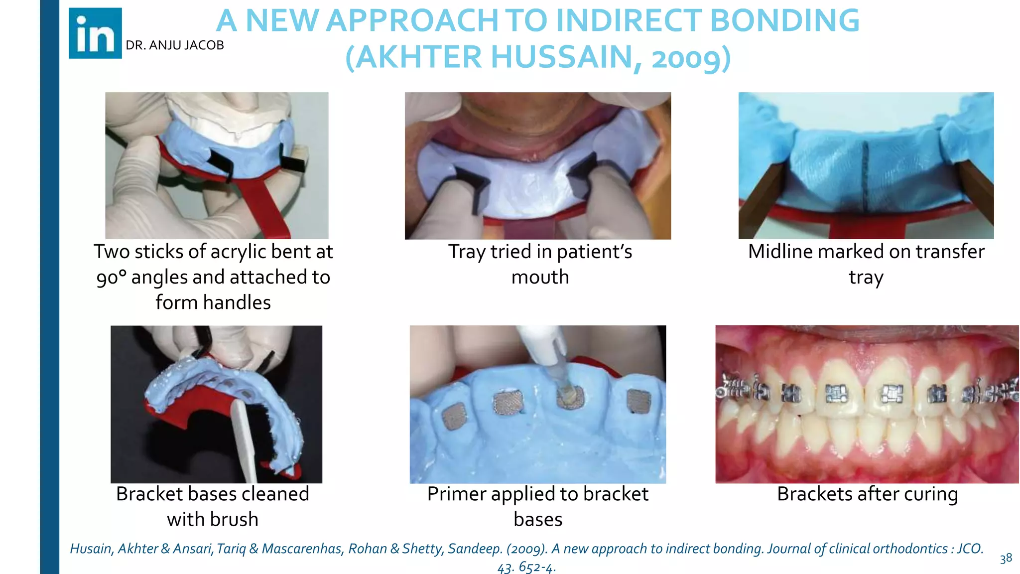 Indirect Bonding in Orthodontics | PPTX