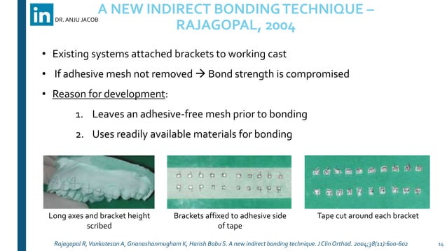 Indirect Bonding in Orthodontics | PPTX