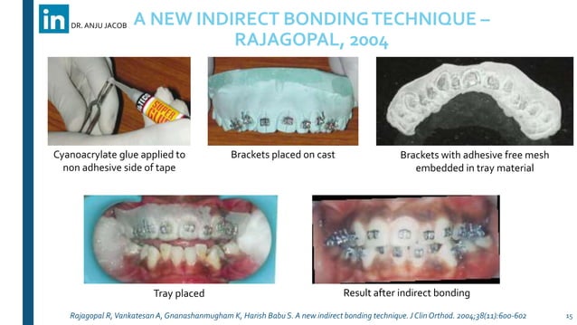 Indirect Bonding in Orthodontics | PPTX