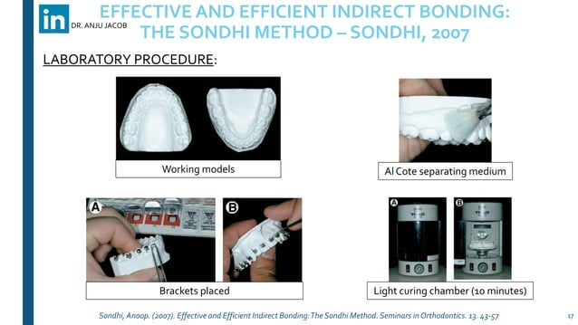 Indirect Bonding in Orthodontics | PPTX