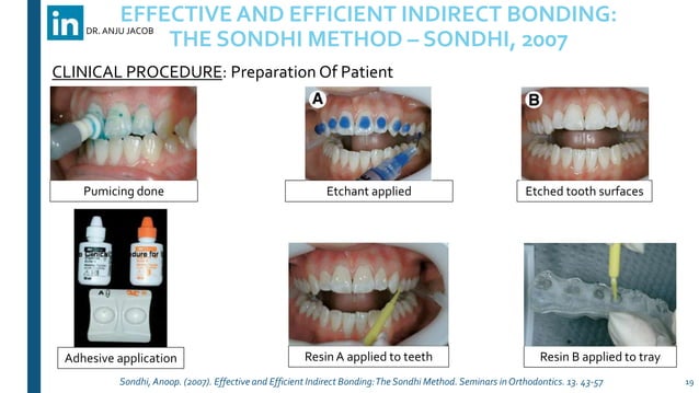 Indirect Bonding in Orthodontics | PPT