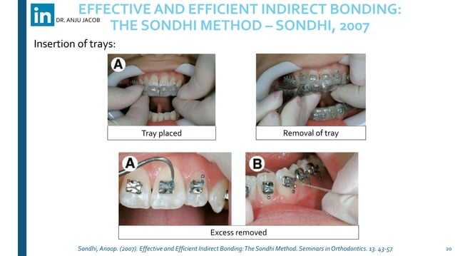 Indirect Bonding in Orthodontics | PPTX