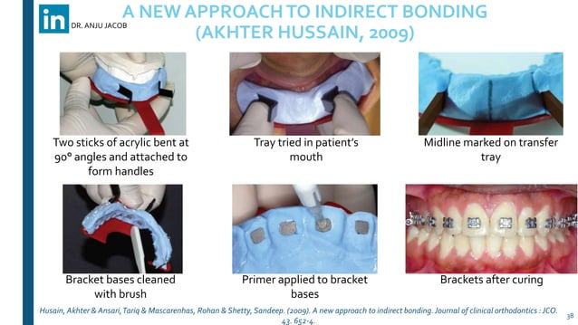 Indirect Bonding in Orthodontics | PPTX
