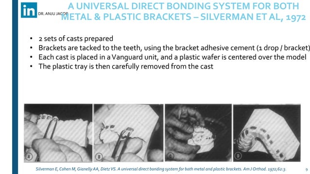 Indirect Bonding in Orthodontics | PPTX