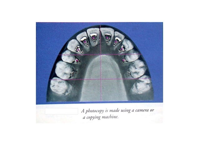 Indirect bonding in lingual orthodontics parag | PPTX | Dental Health ...