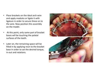 Indirect bonding in lingual orthodontics parag | PPTX