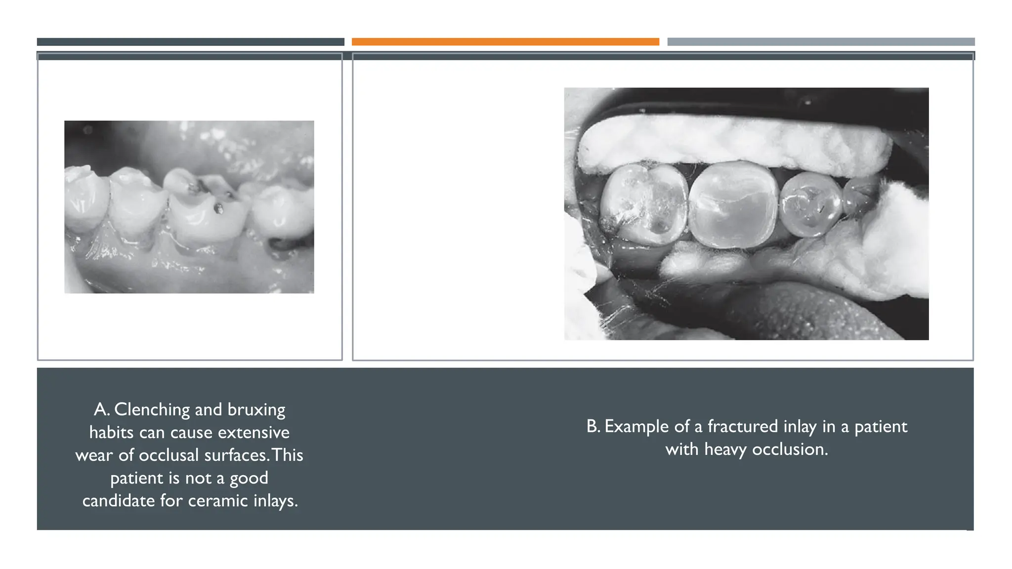 INDIRECT_COMPOSITE_INLAY fixed appliences .pdf