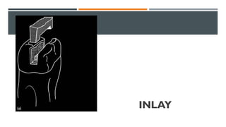 INDIRECT_COMPOSITE_INLAY fixed appliences .pdf