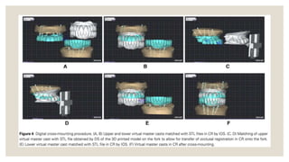 Indirect Digital Workflow for Virtual Cross-Mounting of Fixed Implant ...