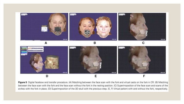 Indirect Digital Workflow for Virtual Cross-Mounting of Fixed Implant ...