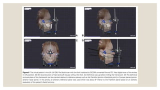 Indirect Digital Workflow for Virtual Cross-Mounting of Fixed Implant ...