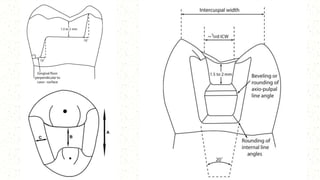 indirect inlay restoration.pptx