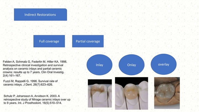 indirect inlay restoration.pptx | Dental Health | Diseases and Conditions