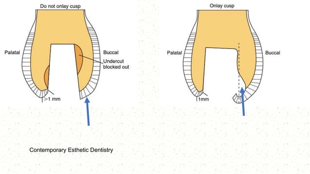 indirect inlay restoration.pptx | Dental Health | Diseases and Conditions