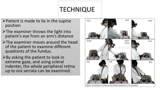 INDIRECT OPHTHALMOSCOPE.pptx