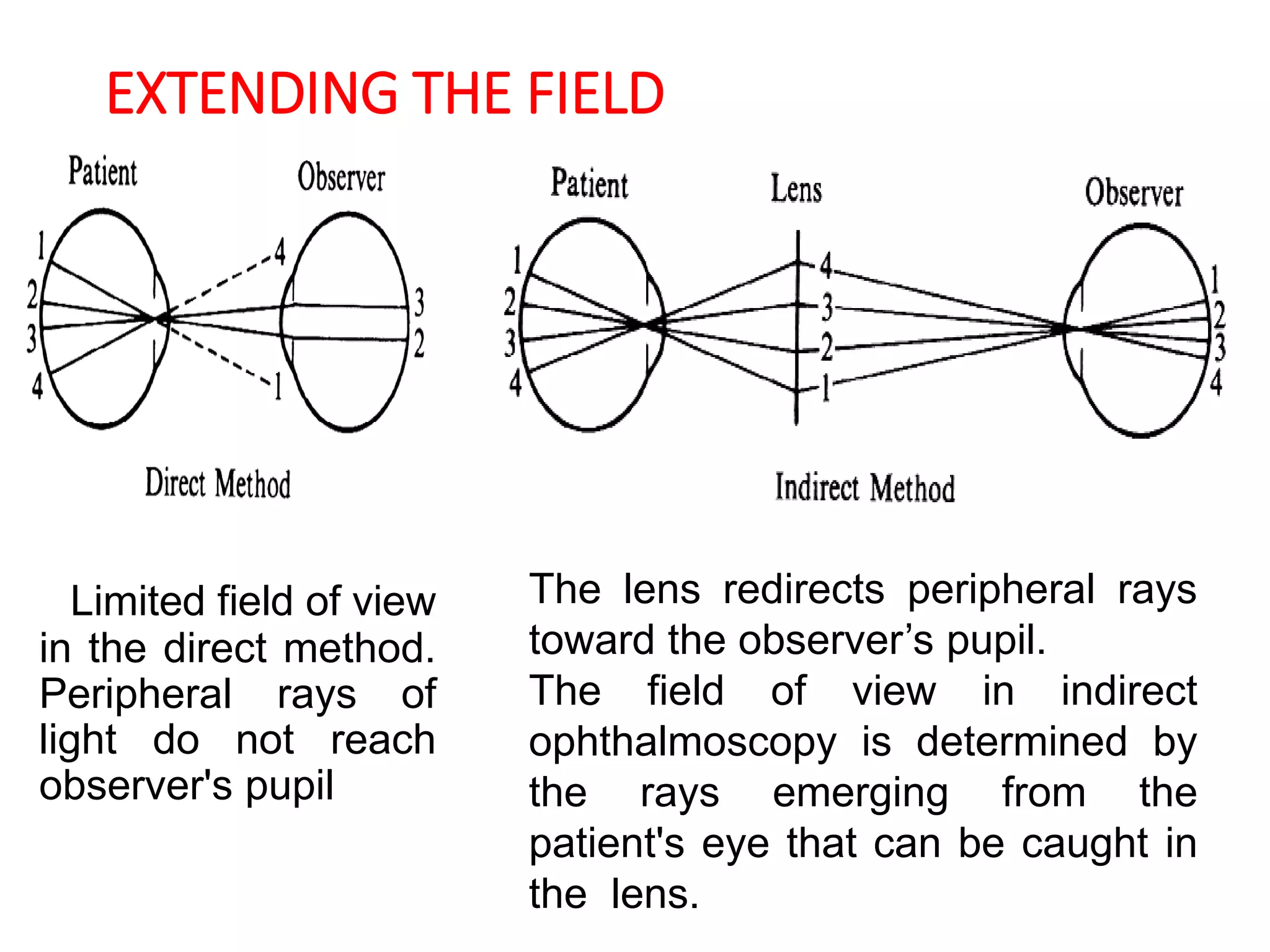 Indirect ophthalmoscopy | PPTX