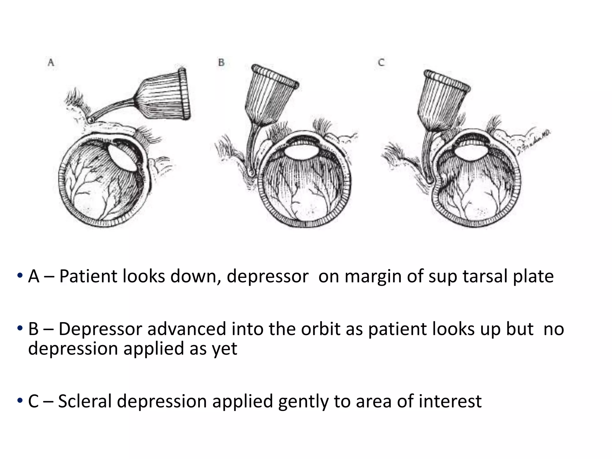 Indirect ophthalmoscopy | PPTX