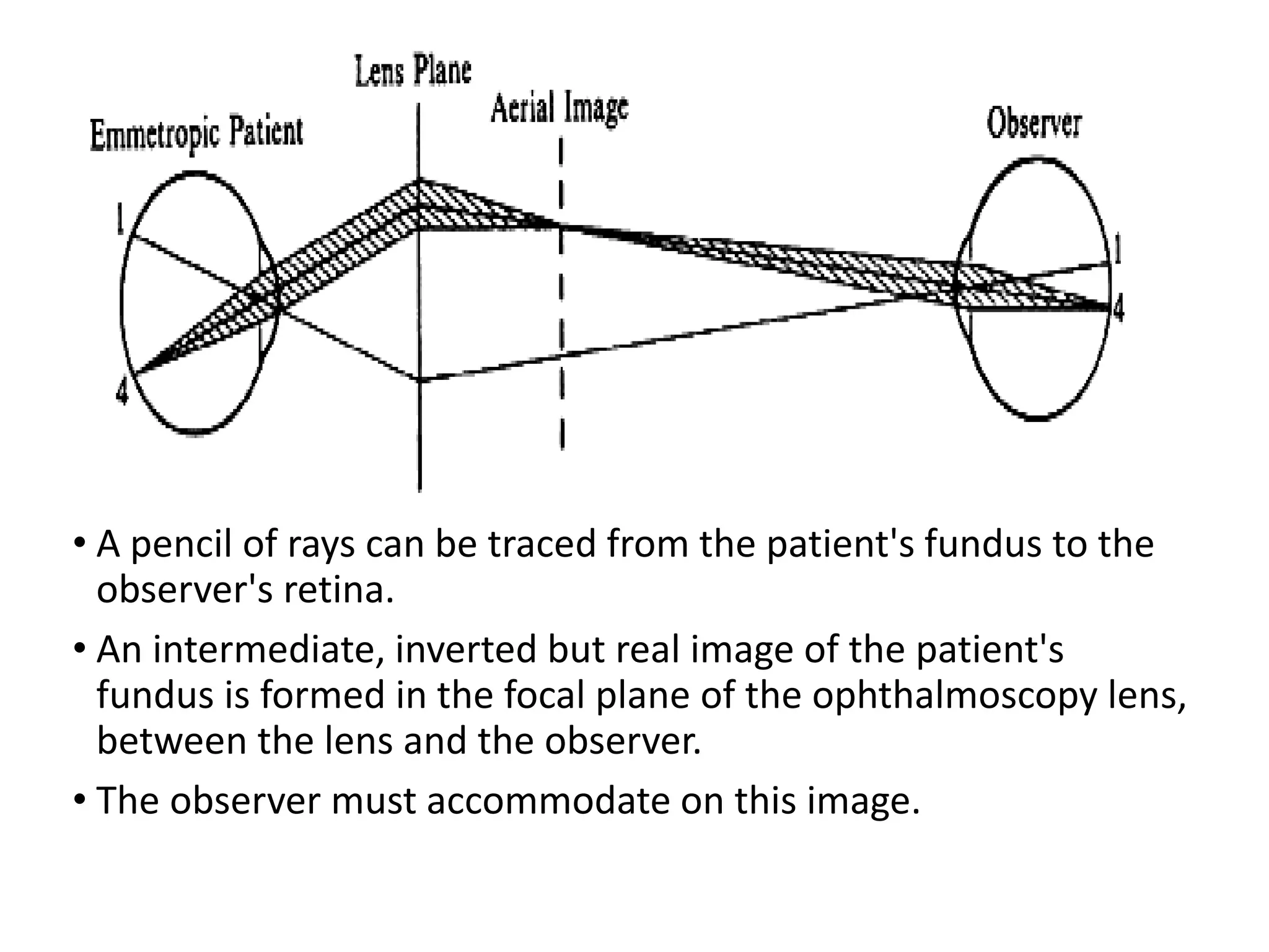 Indirect ophthalmoscopy | PPTX
