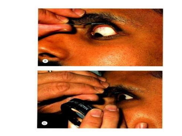 Indirect ophthalmoscopy | PPTX | Eye and Vision Conditions | Diseases ...